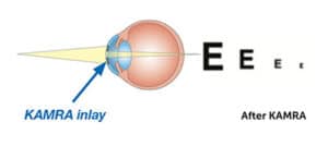 Near Vision Treatment | Raindrop Inlay & KAMRA Inlay | CEC